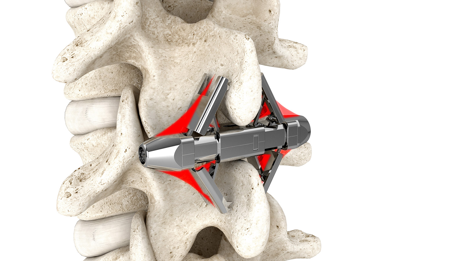 Device QFusion Interspinous Fusion and Stabilization System - QFusion Spine